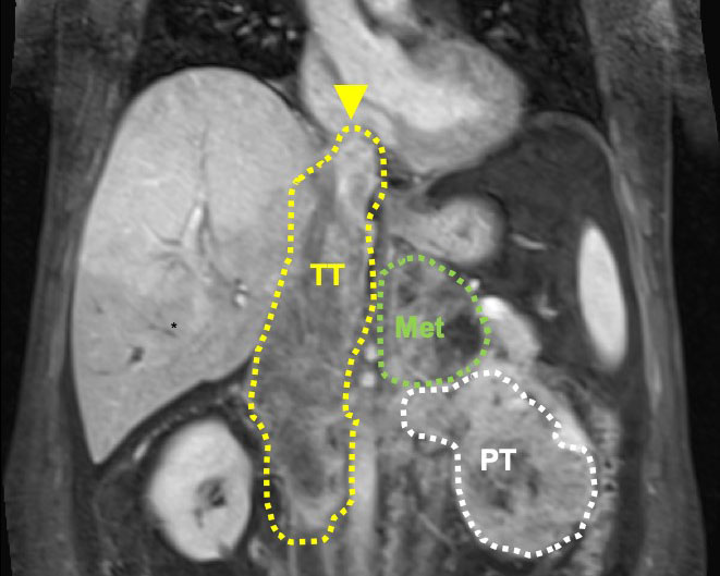 Kidney Cancer Program - UT Southwestern, Dallas, Texas
