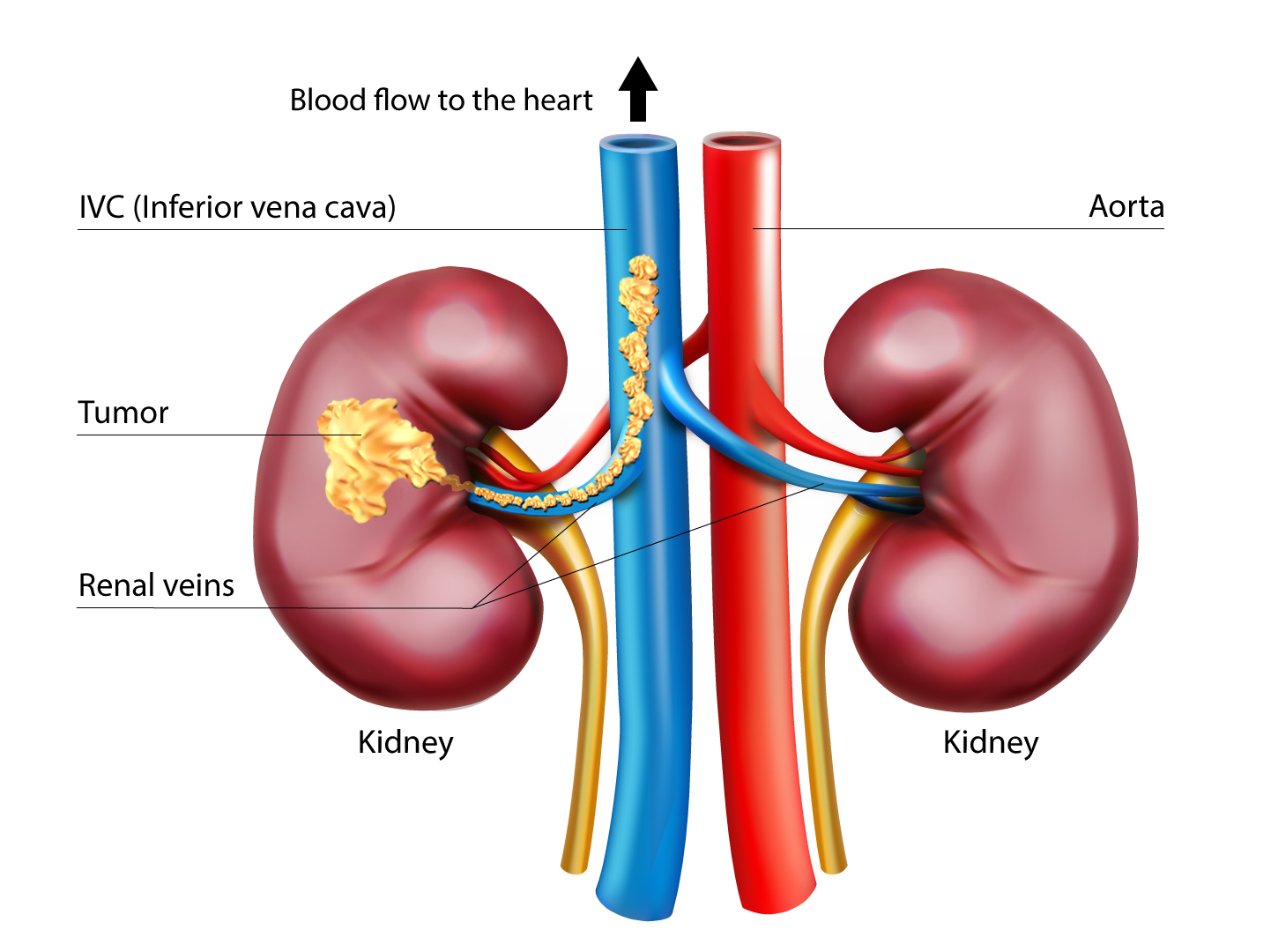 Kidney Cancer Program - UT Southwestern, Dallas, Texas